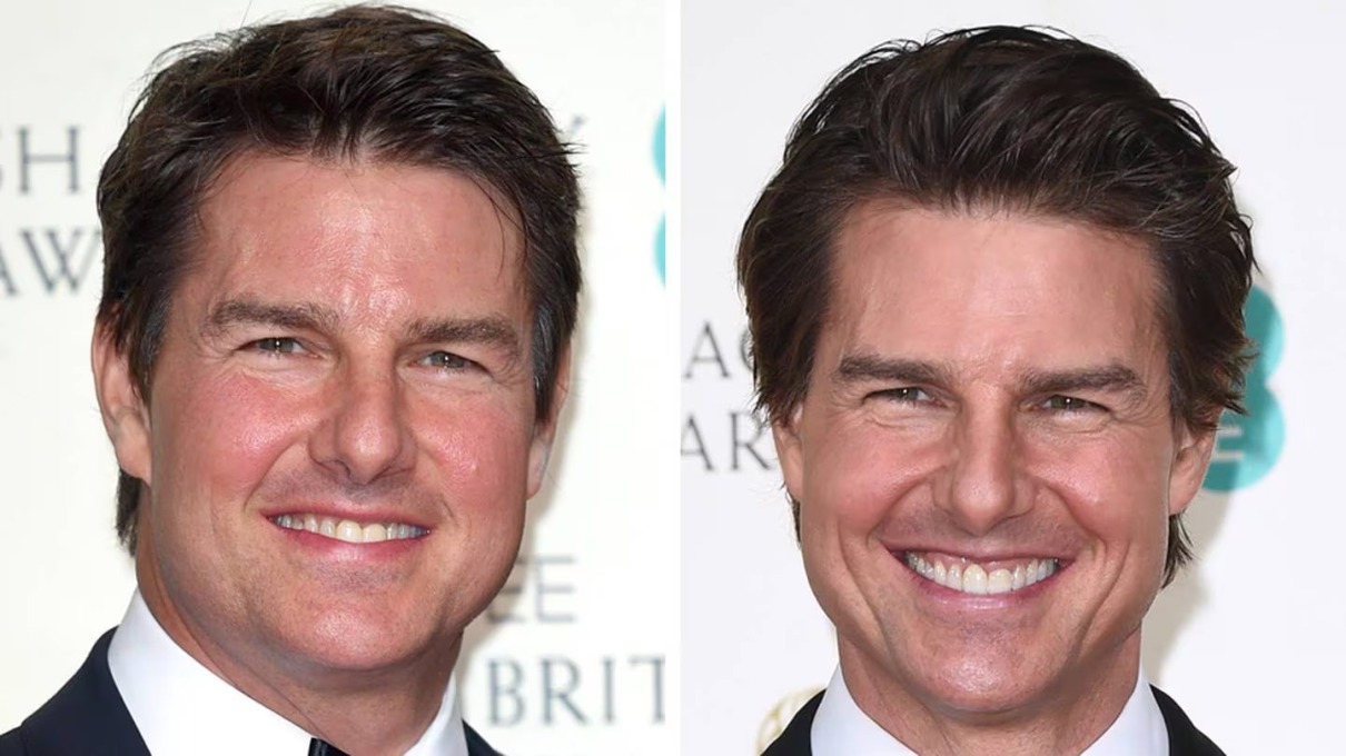 Tom Cruise Plastic Surgery Before And After